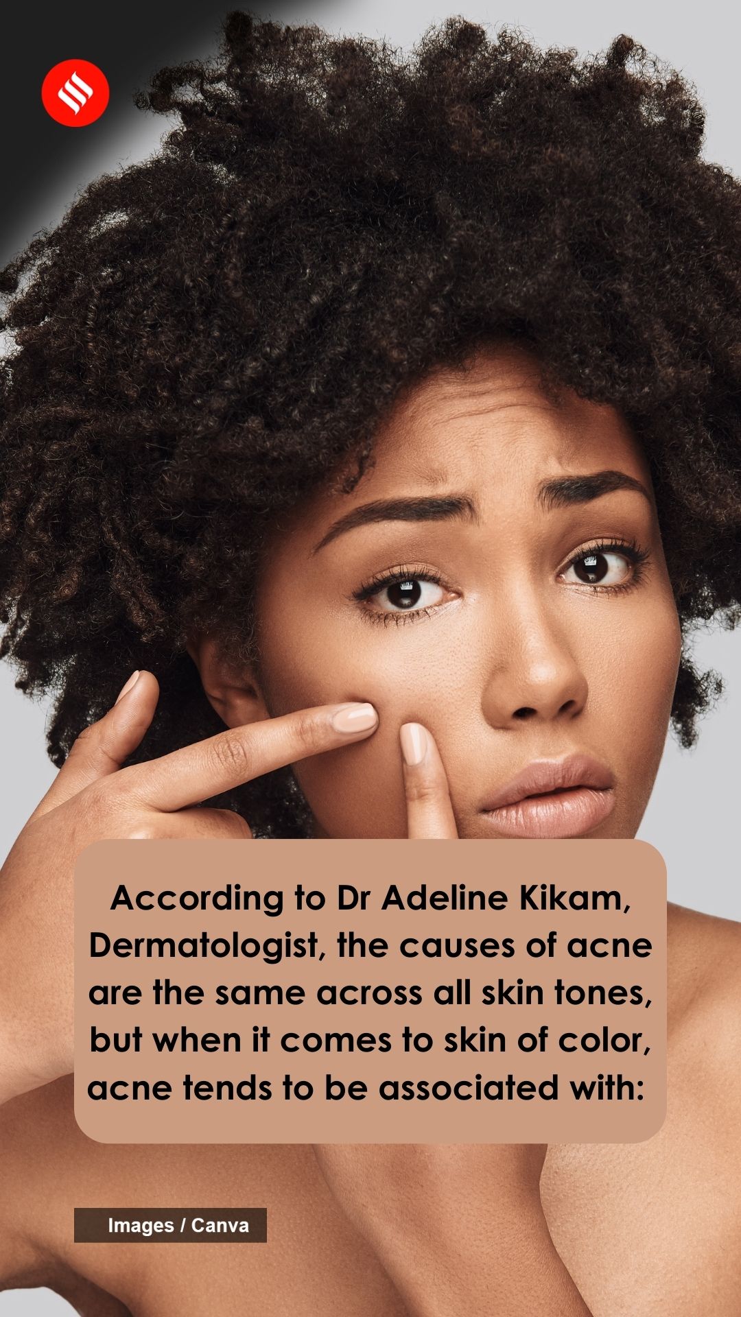 Acne in skin of color | The Indian Express