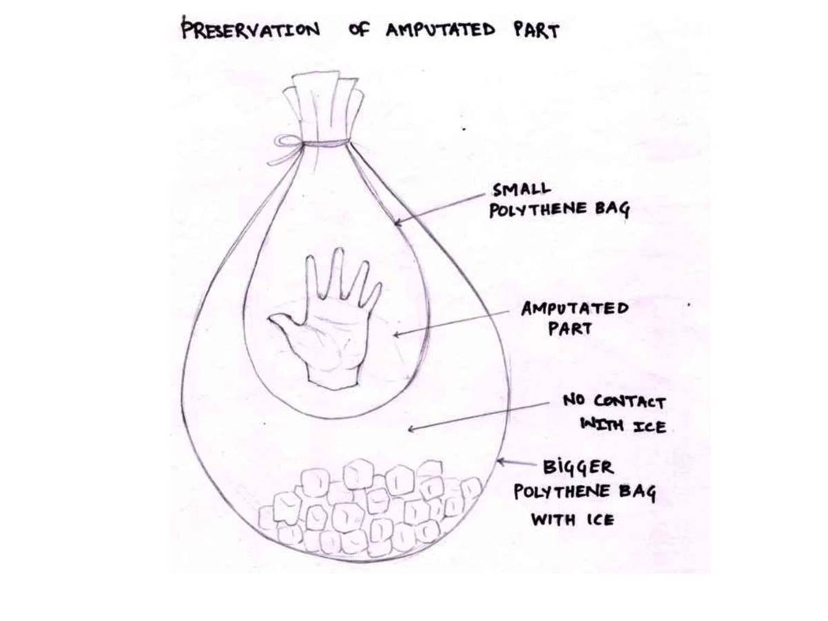 Rare surgery: Three fingers rejoined, a thumb reconstructed from toe ...