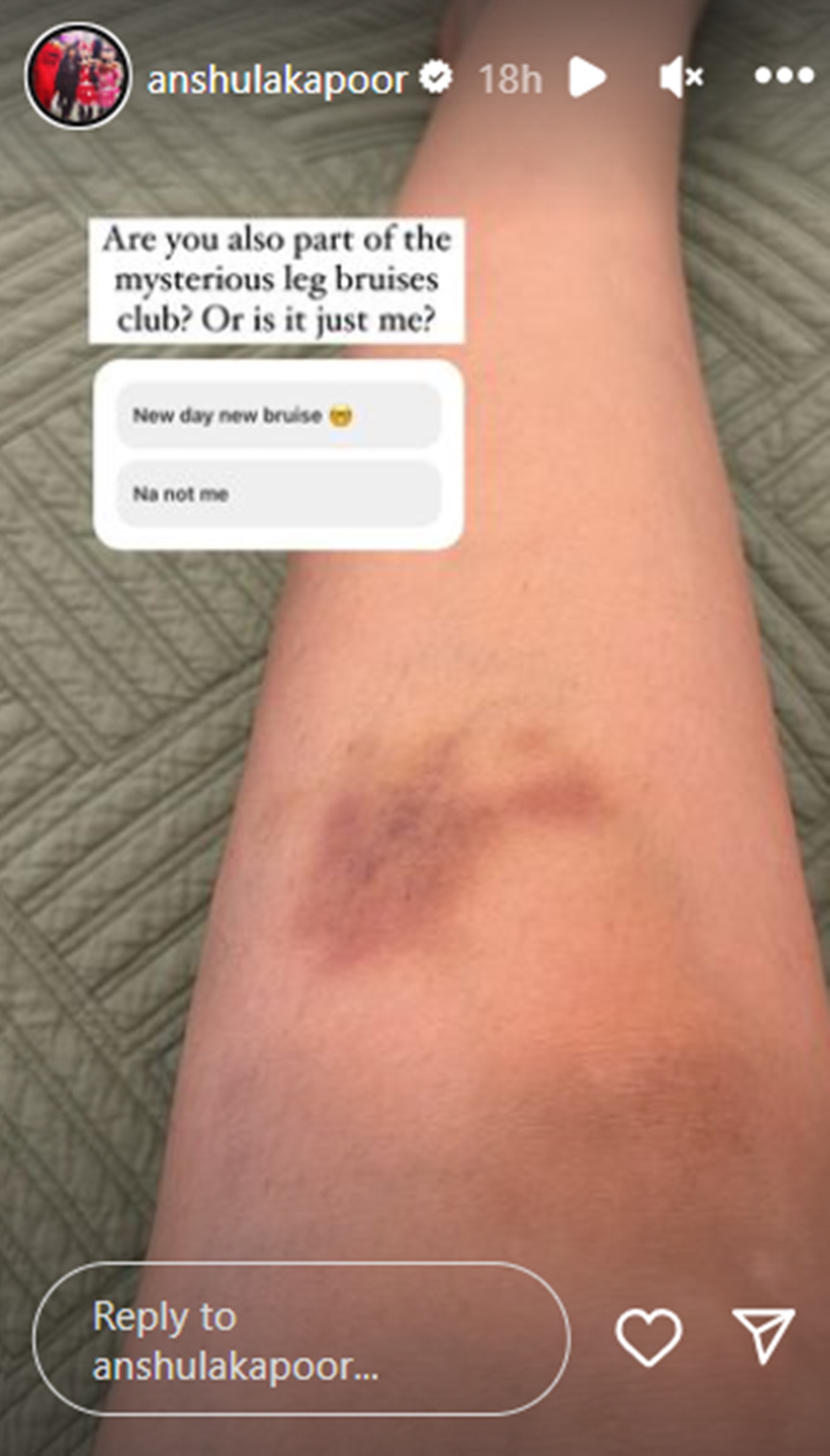 Have you ever noticed ‘mysterious’ bruises on your legs, arms and other ...