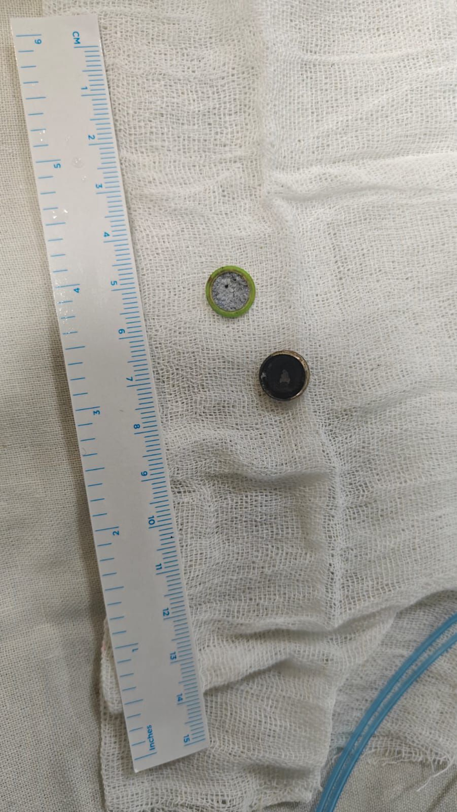 Small battery retrieved from five-month-old infant’s food pipe at ...